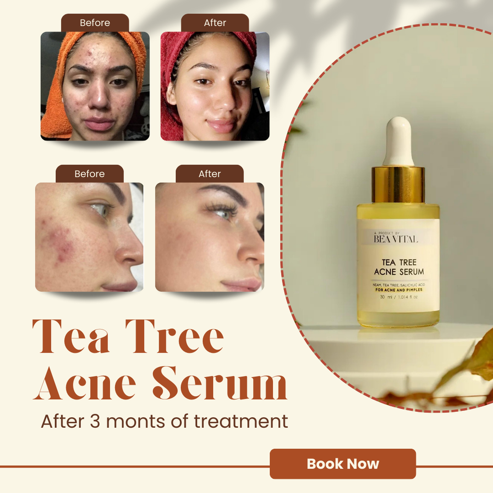 Tea Tree Acne Serum - 30ml For Acne & Pimples With Tea Tree & Salicyli